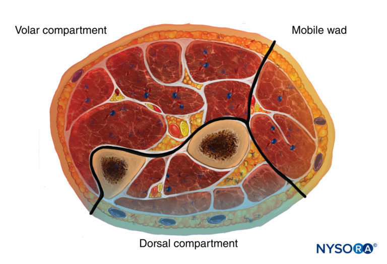 Acute Compartment Syndrome of the Limb: Implications for Regional ...