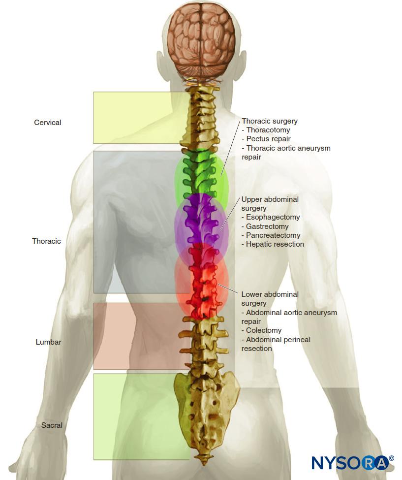 Thoracic Epidural Placement