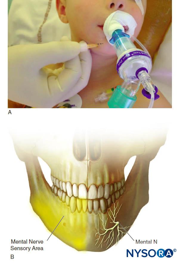 Nerve Blocks of the Face - NYSORA