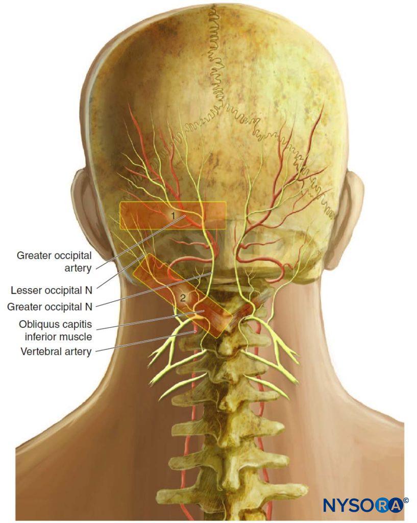 Occipital Nerve Block Injection Occipital Nerve Block Injection