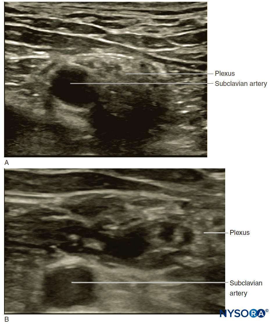 Ultrasound-Guided Interscalene Brachial Plexus Block - NYSORA
