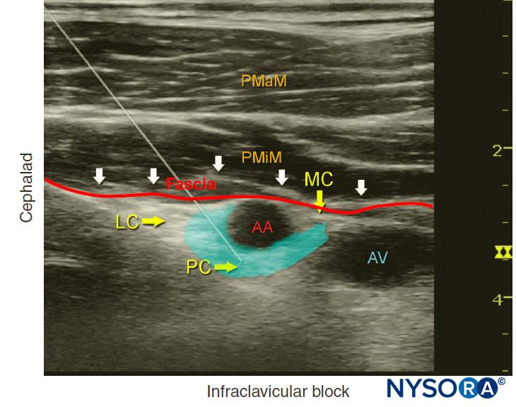 Ultrasound-Guided Infraclavicular Brachial Plexus Block - NYSORA