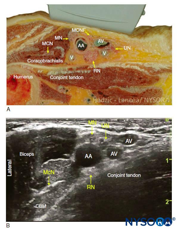 Ultrasound-Guided Axillary Brachial Plexus Block - NYSORA