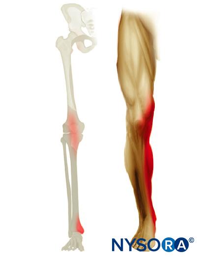 Ultrasound-Guided Saphenous (Adductor Canal) Nerve Block - NYSORA