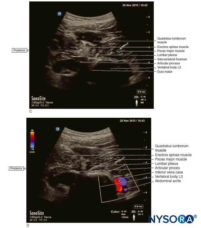 Sonography Of The Lumbar Paravertebral Space And Considerations For The