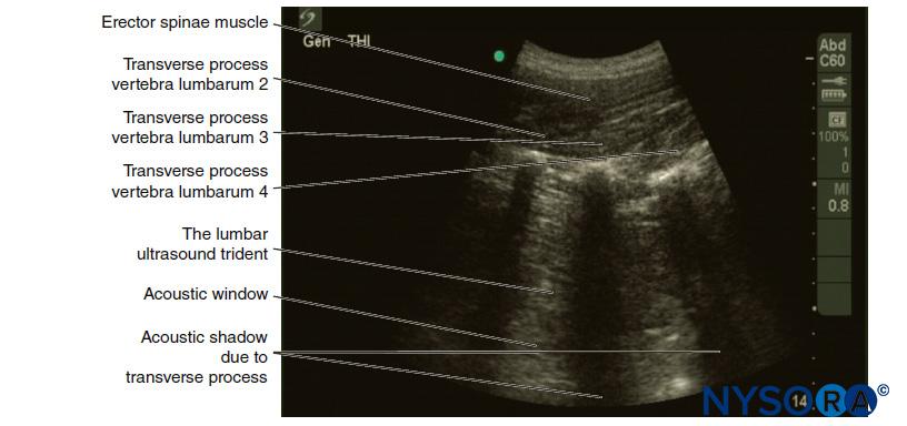 Lumbar Paravertebral Sonography And Considerations For Ultrasound