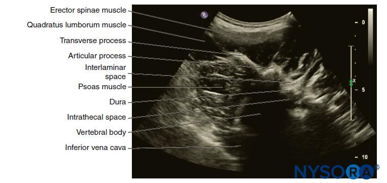Lumbar Paravertebral Sonography And Considerations For Ultrasound