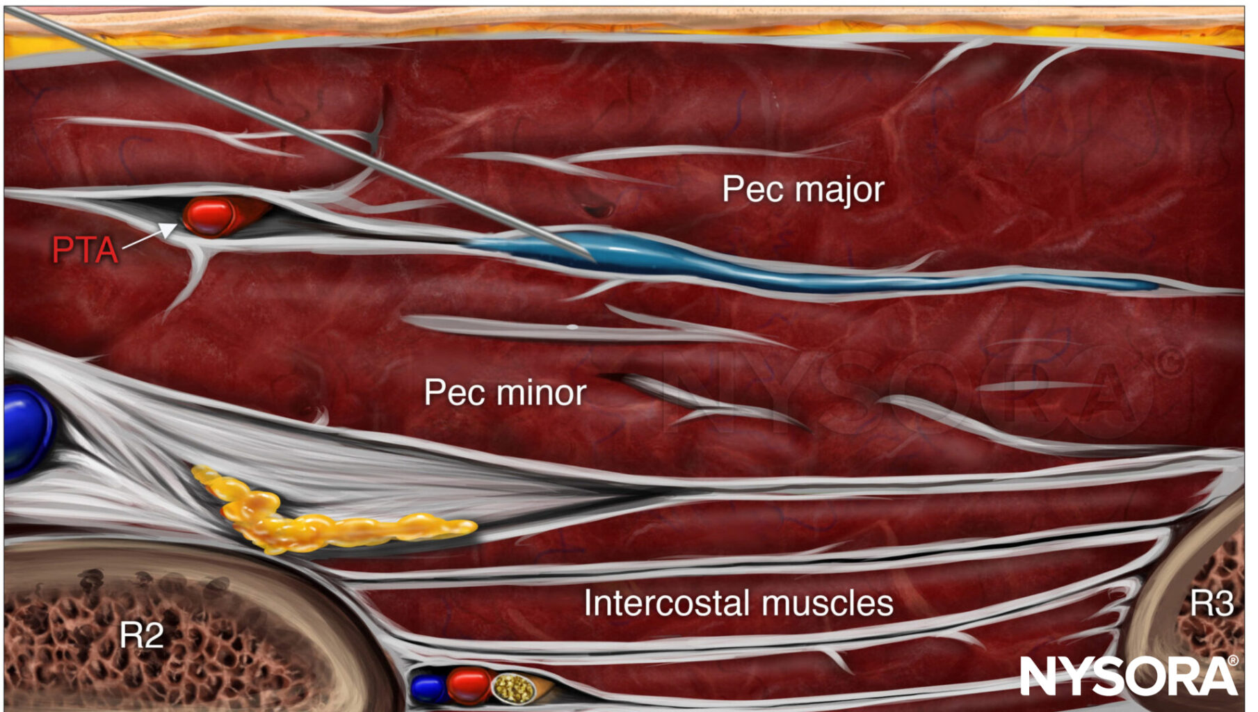 Pectoralis and Serratus Plane Nerve Blocks - NYSORA