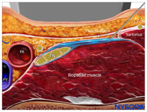 Ultrasound-Guided Fascia Iliaca Nerve Block - NYSORA