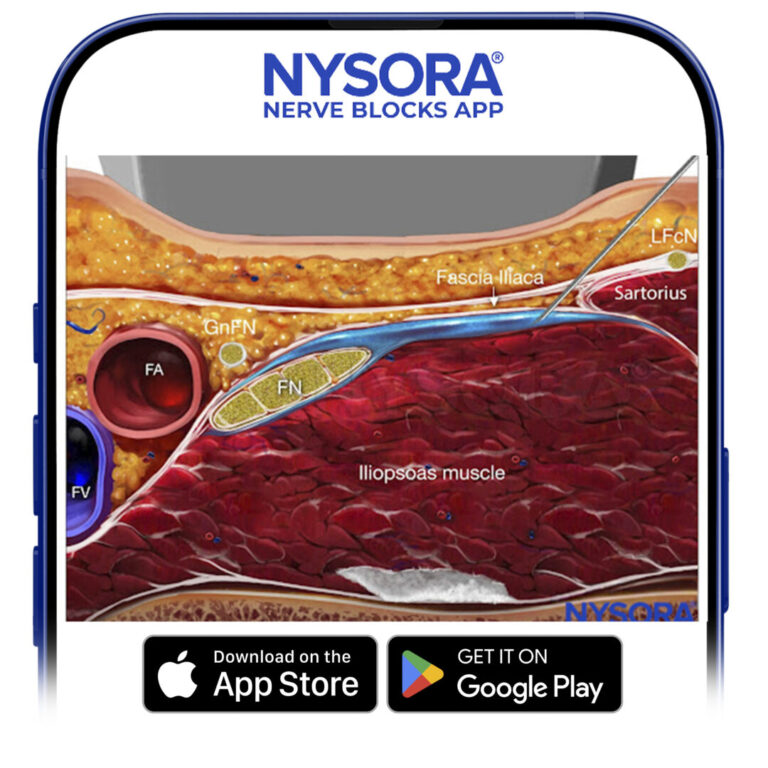 Ultrasound-Guided Fascia Iliaca Nerve Block - NYSORA