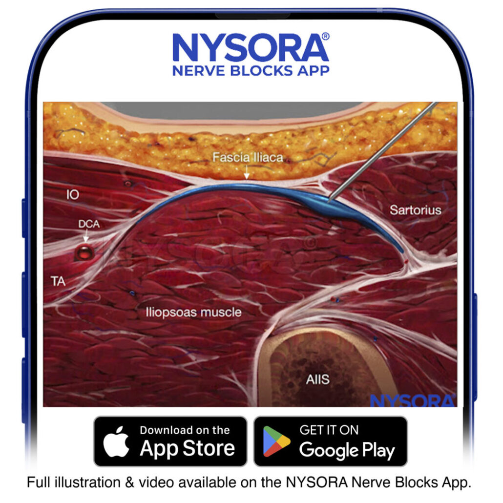 Ultrasound-Guided Fascia Iliaca Nerve Block - NYSORA