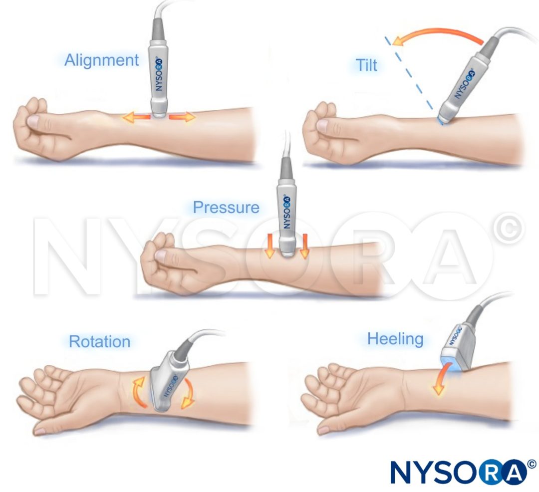Optimizing an Ultrasound Image - NYSORA