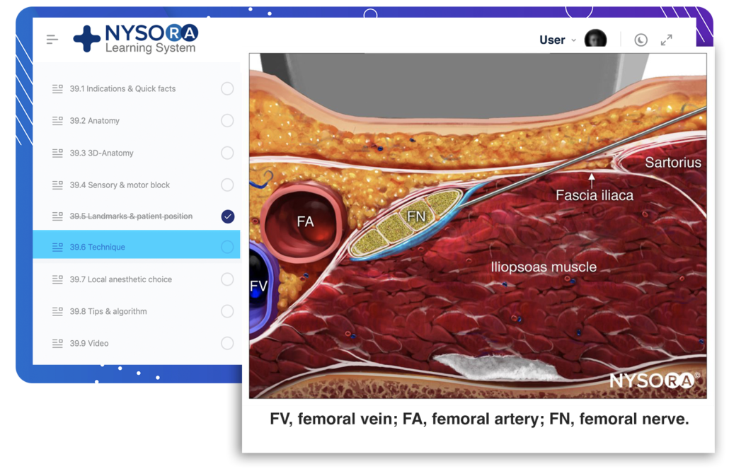 femoral - NYSORA | NYSORA