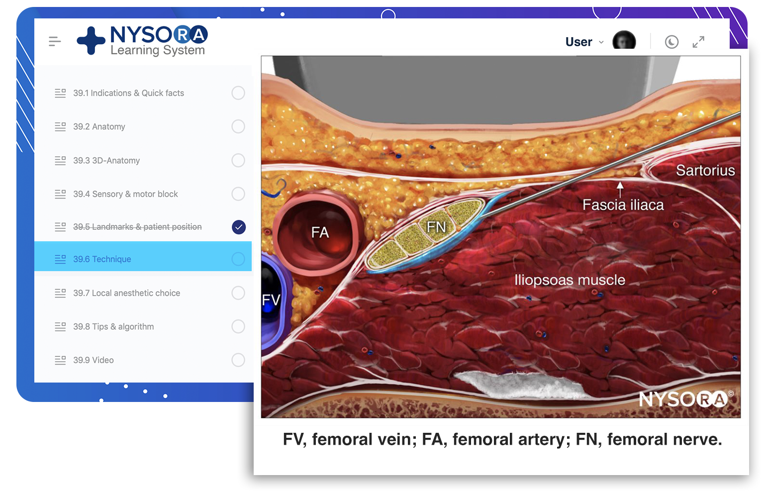 Femoral NYSORA NYSORA