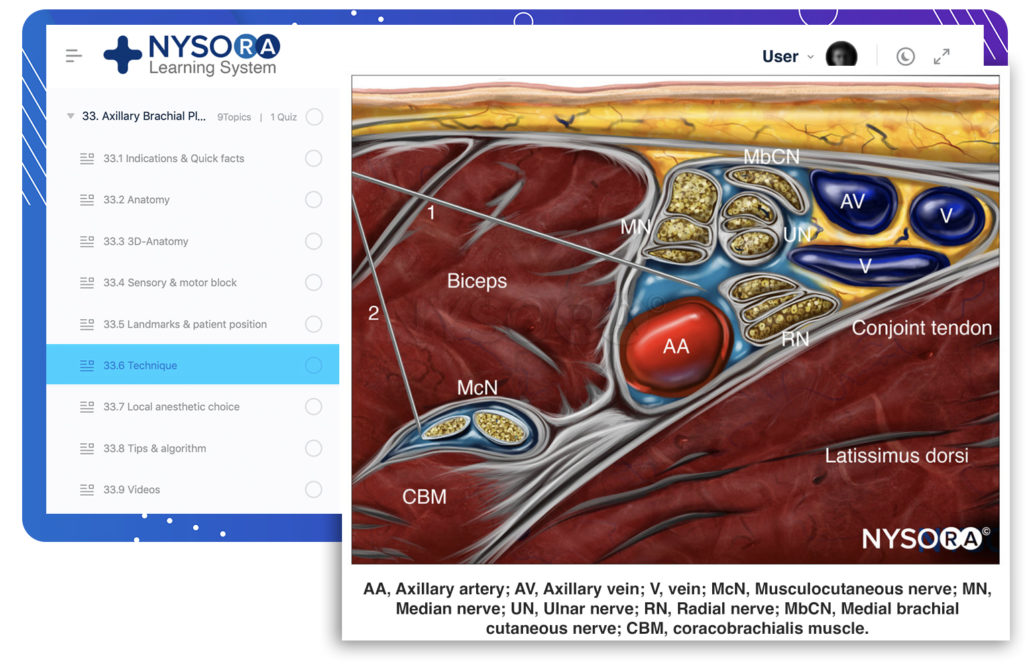 Ultrasound Guided Axillary Brachial Plexus Block Nysora