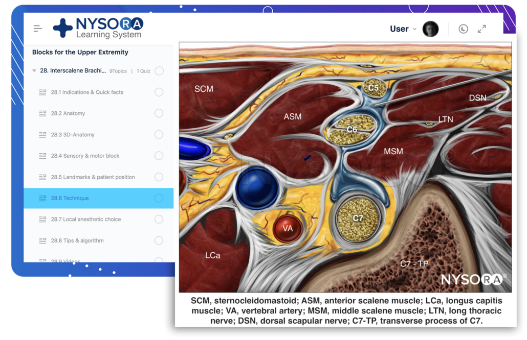 Shoulder Surgery - NYSORA