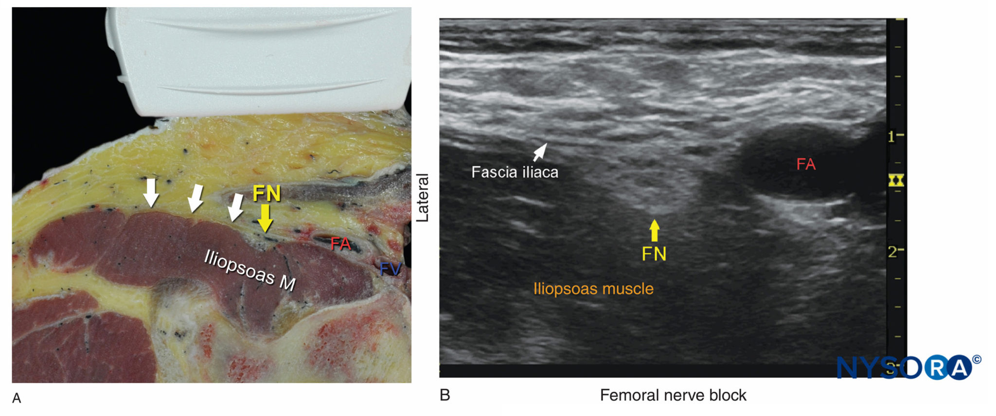 Ultrasound-Guided Femoral Nerve Block - NYSORA