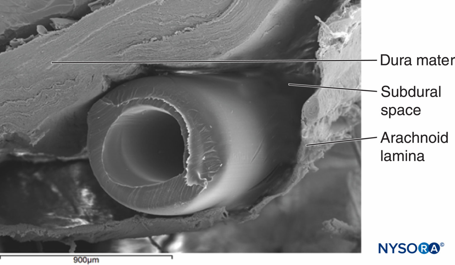 Spinal Anesthesia - NYSORA