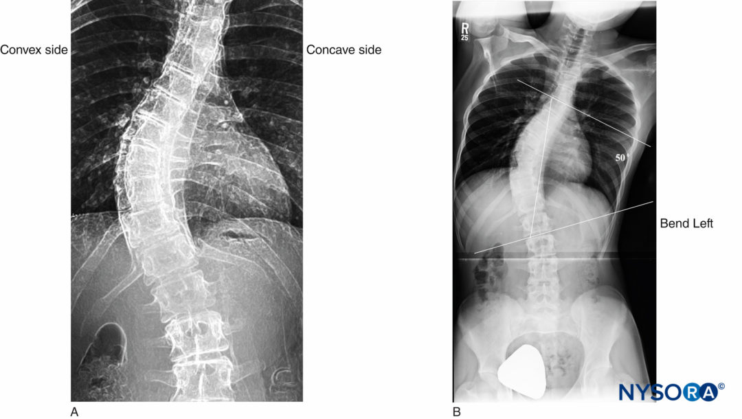 Neuraxial Anatomy - NYSORA