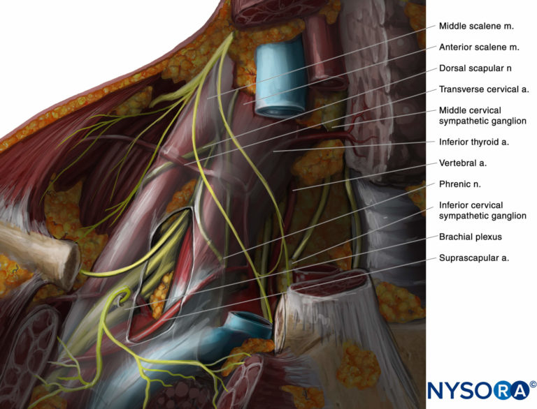 Ultrasound-Guided Interscalene Brachial Plexus Nerve Block - NYSORA