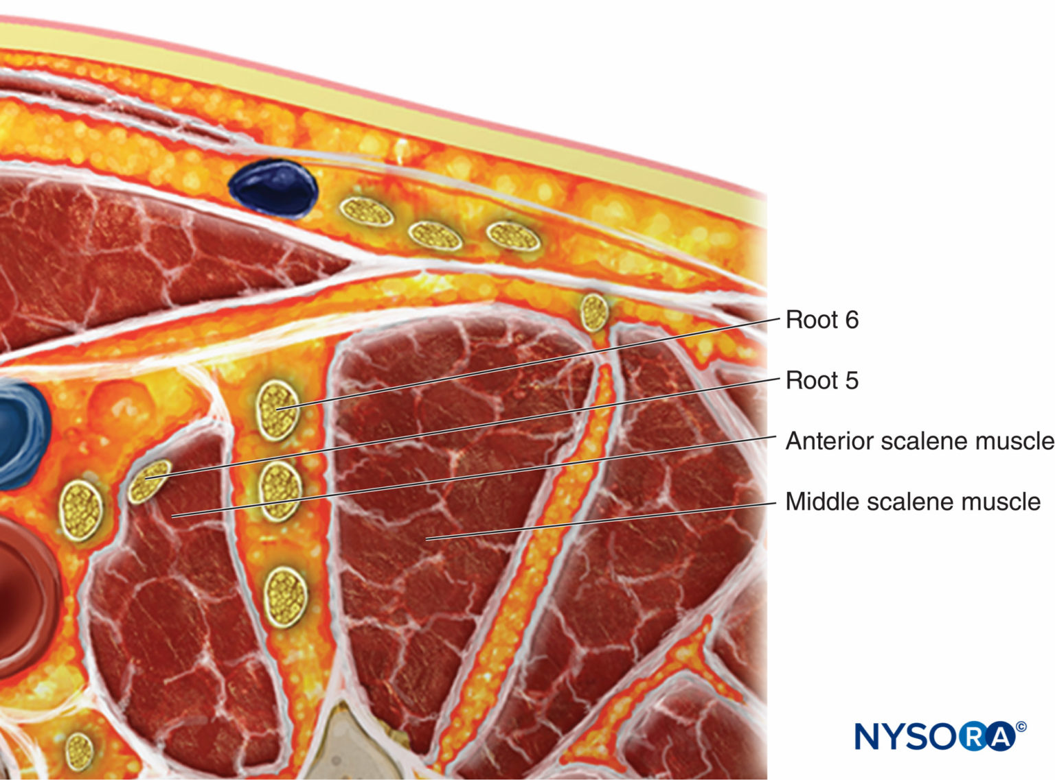 Ultrasound-Guided Interscalene Brachial Plexus Nerve Block - NYSORA