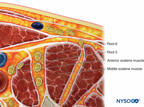Bloqueo interescalénico del plexo braquial guiado por ecografía - NYSORA