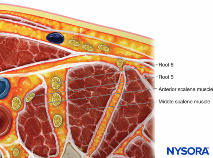 Ultrasound-Guided Interscalene Brachial Plexus Nerve Block - NYSORA