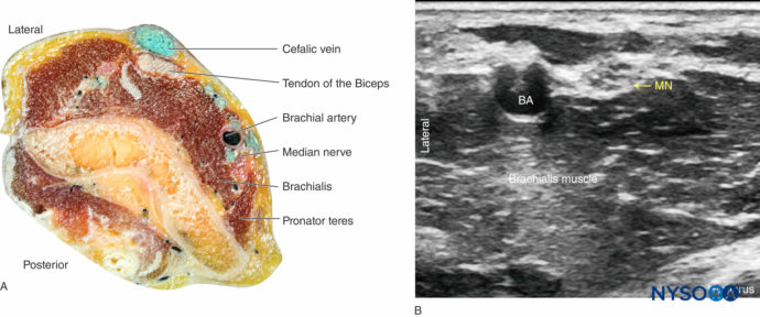 Ultrasound-Guided Blocks at the Elbow - NYSORA