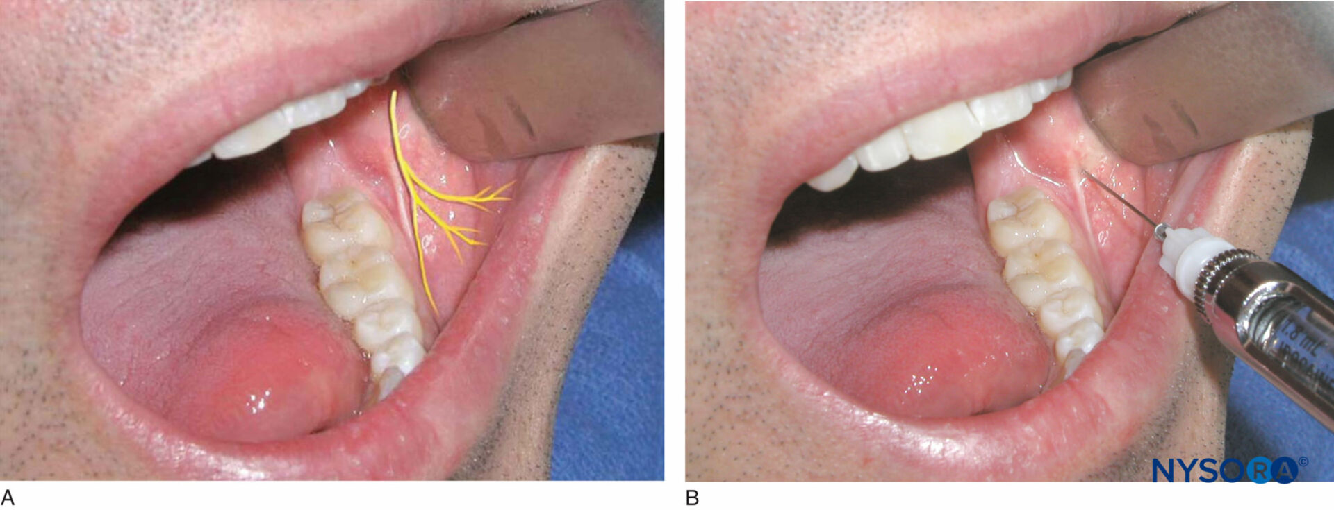 regional-anesthesia-buccal-nerve-location-tissue-just-distal-and-buccal ... regional-anesthesia-buccal-nerve-location-tissue-just-distal-and-buccal ...