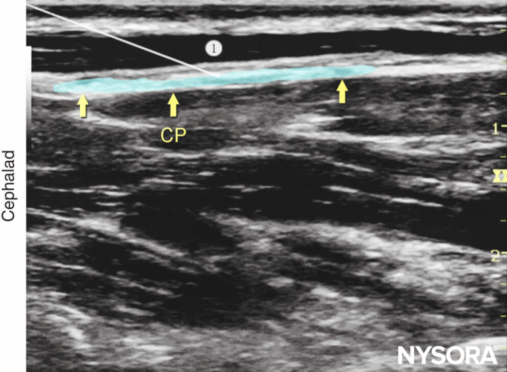 Ultrasound-Guided Cervical Plexus Nerve Block - NYSORA