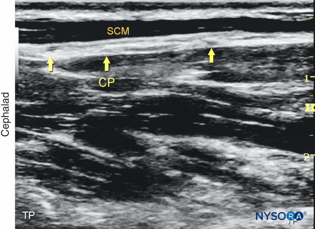 Ultrasound-Guided Cervical Plexus Nerve Block - NYSORA