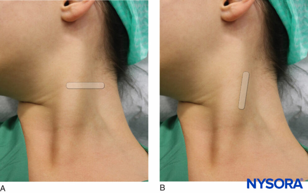 Ultrasound-Guided Cervical Plexus Nerve Block - NYSORA