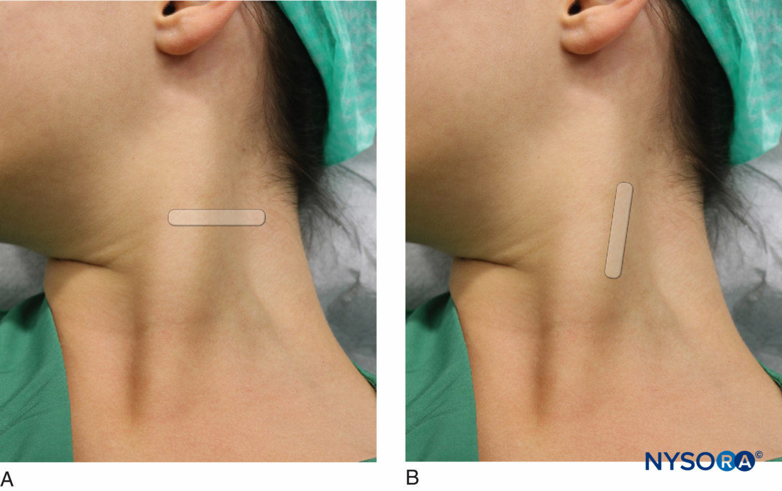 Ultrasound Guided Cervical Plexus Nerve Block Nysora