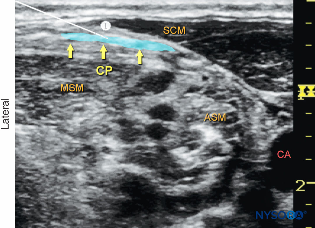 Ultrasound-Guided Cervical Plexus Nerve Block - NYSORA