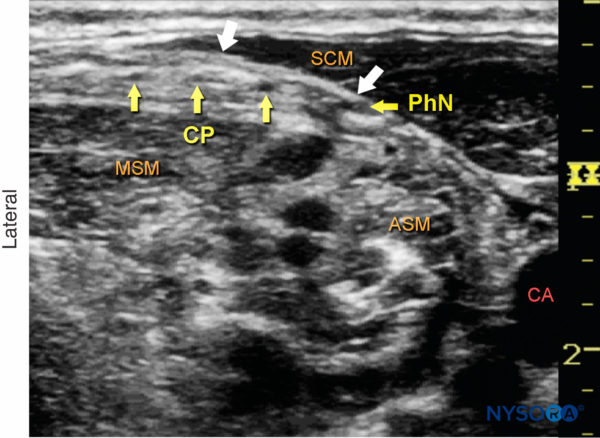 Ultrasound-Guided Cervical Plexus Nerve Block - NYSORA