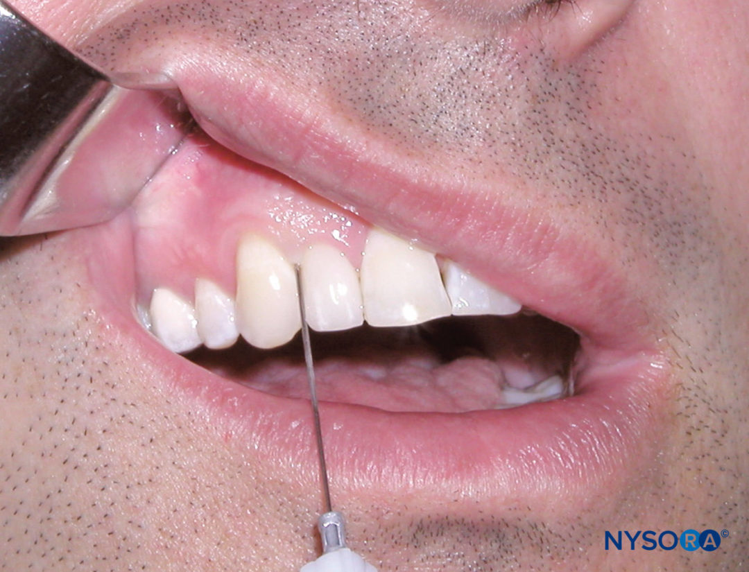 Oral & Maxillofacial Regional Anesthesia - NYSORA | NYSORA