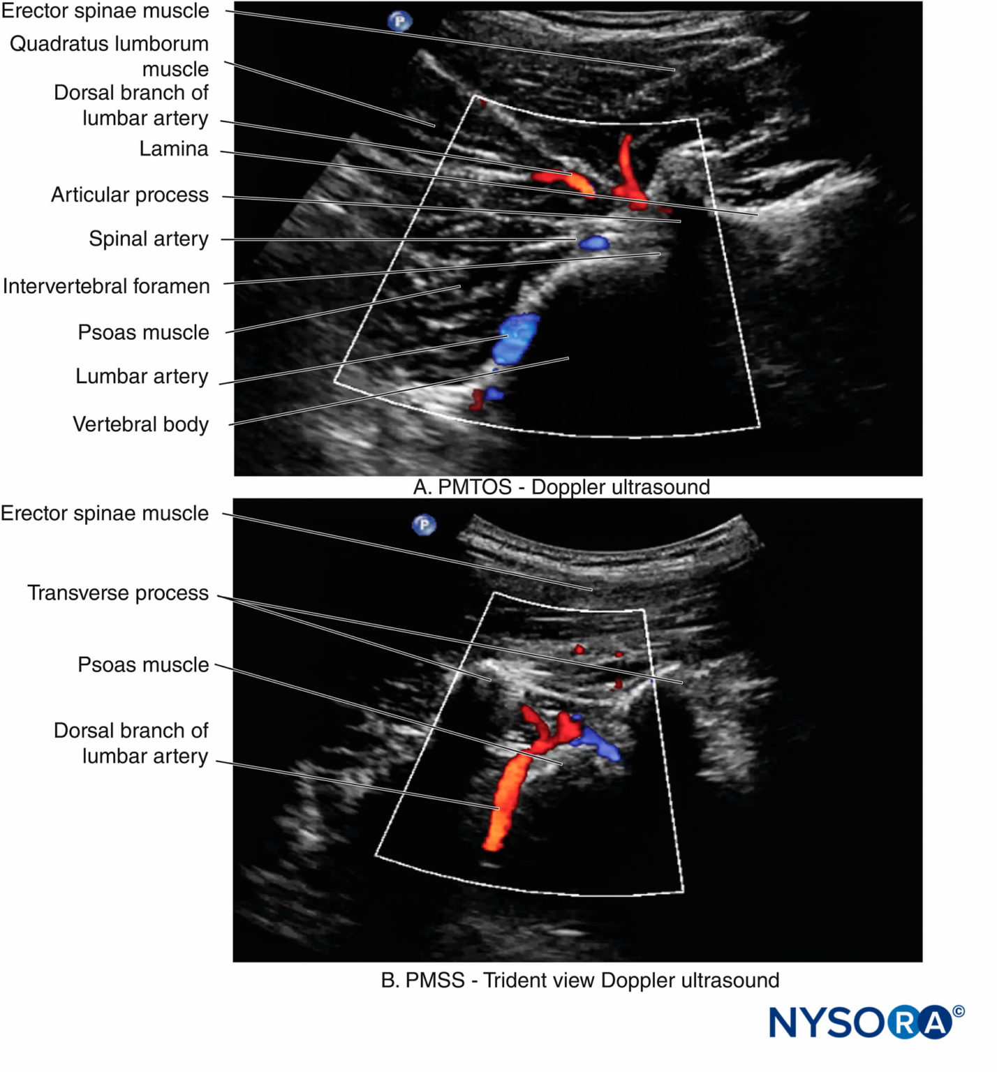 Lumbar Paravertebral Sonography And Considerations For Ultrasound