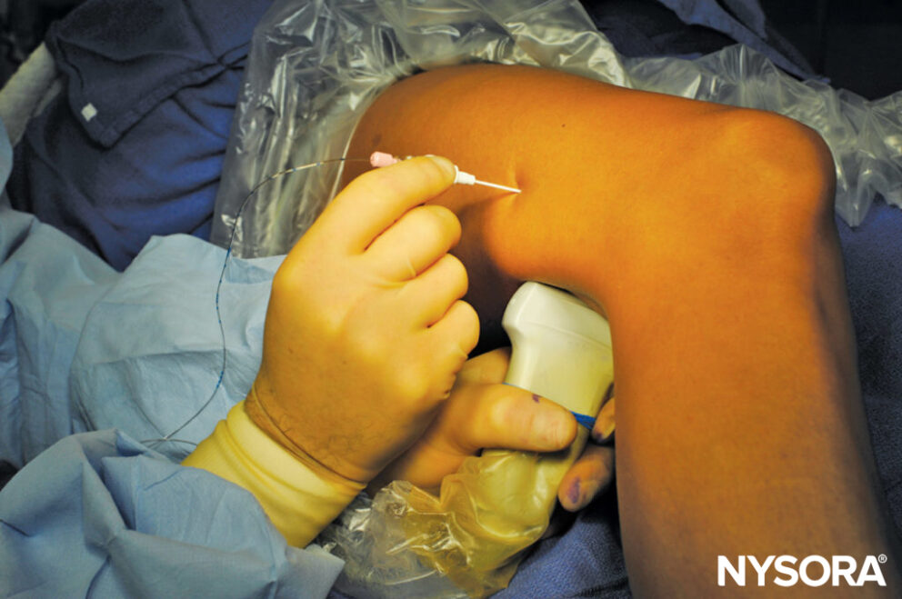 Ultrasound-Guided Popliteal Sciatic Nerve Block - NYSORA