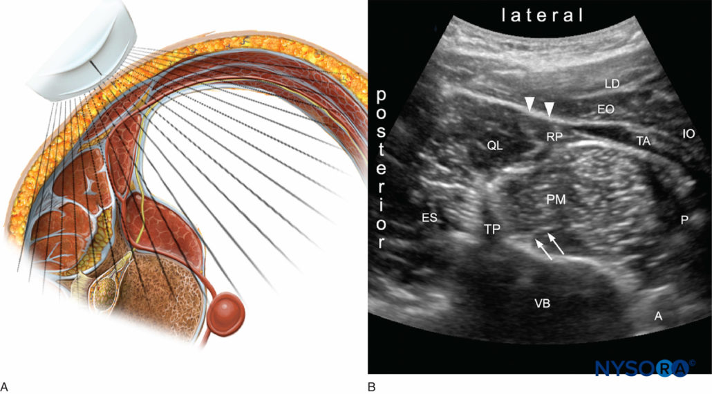 Ultrasound-Guided Transversus Abdominis Plane and Quadratus Lumborum ...