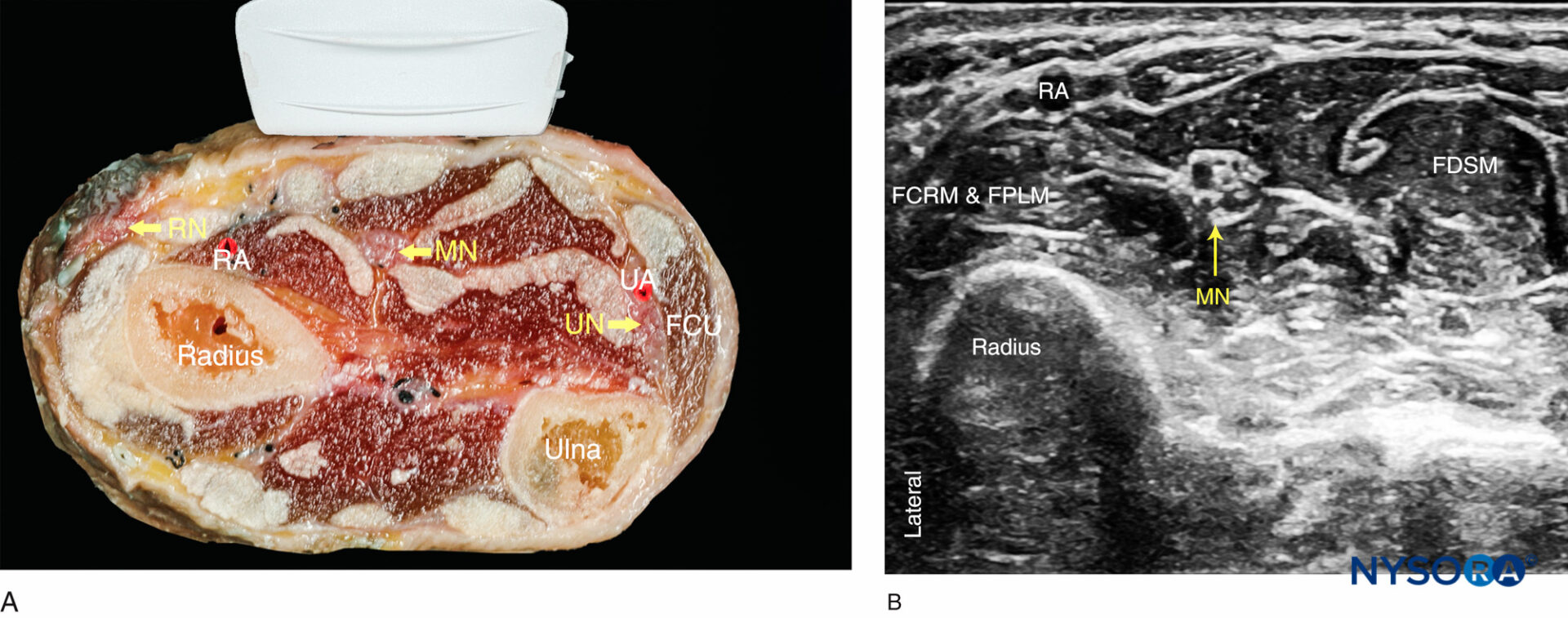 Regional Anesthesia Cross Sectional Anatomy Of Distal Forearm And Sonoanatomy Of Median Nerve At