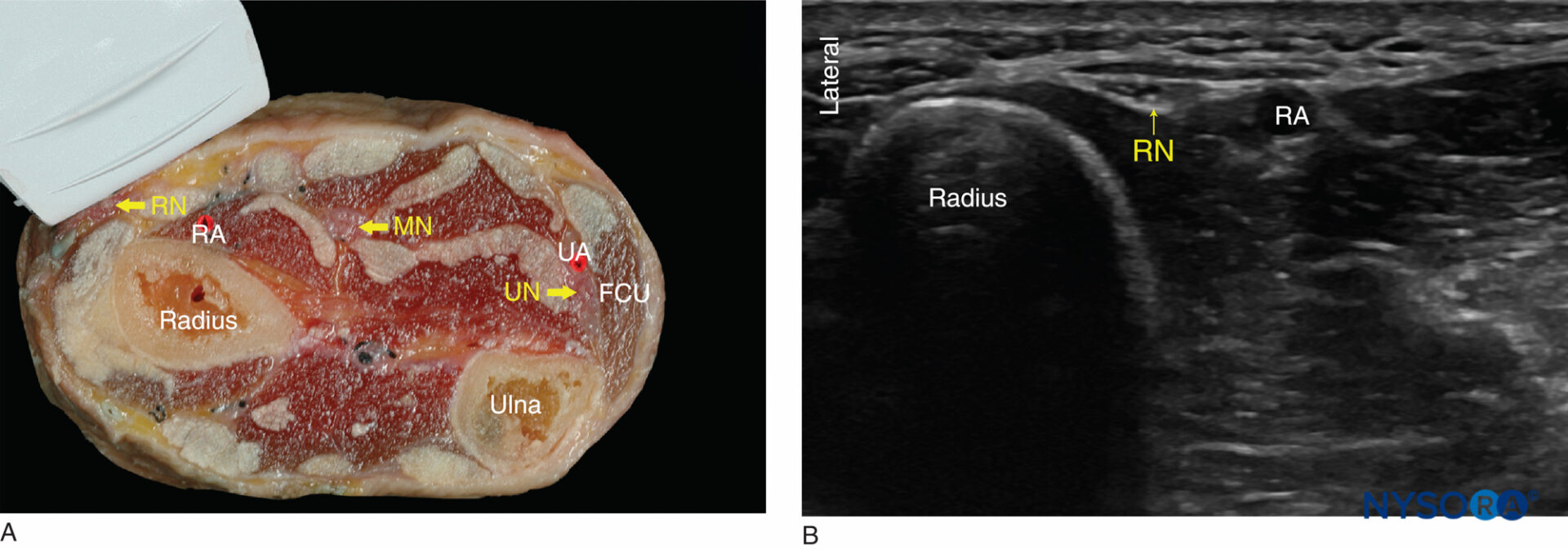 Ultrasound-Guided Wrist Nerve Block - NYSORA
