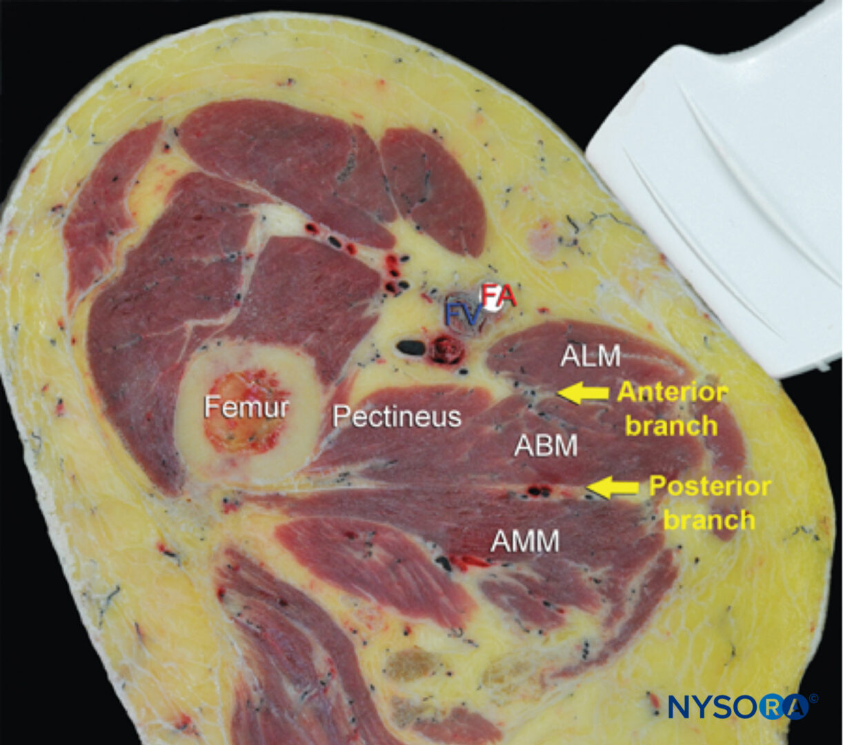 Regional Anesthesia Cross Sectional Anatomy Of Relevance To The Obturator Nerve Block Nysora
