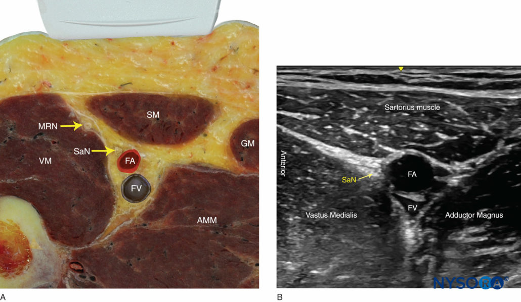 超声引导大隐（内收管）神经阻滞 - NYSORA
