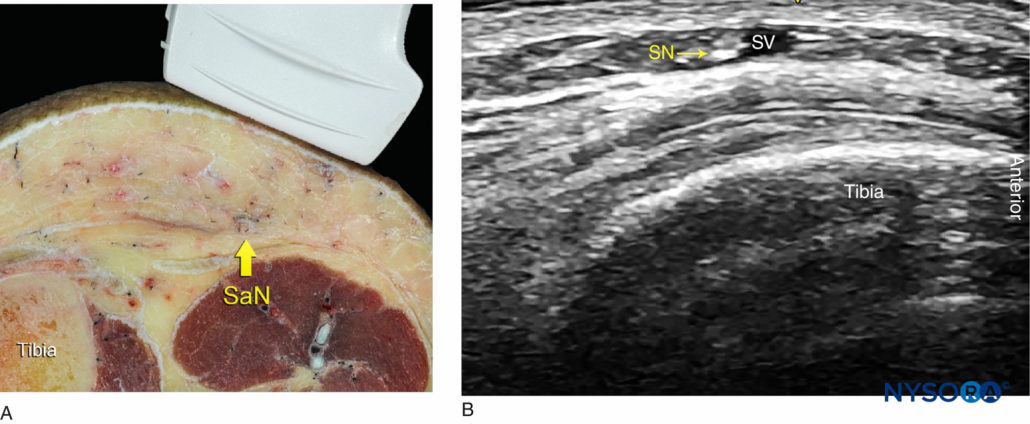 Ultrasound-Guided Saphenous (Adductor Canal) Nerve Block - NYSORA