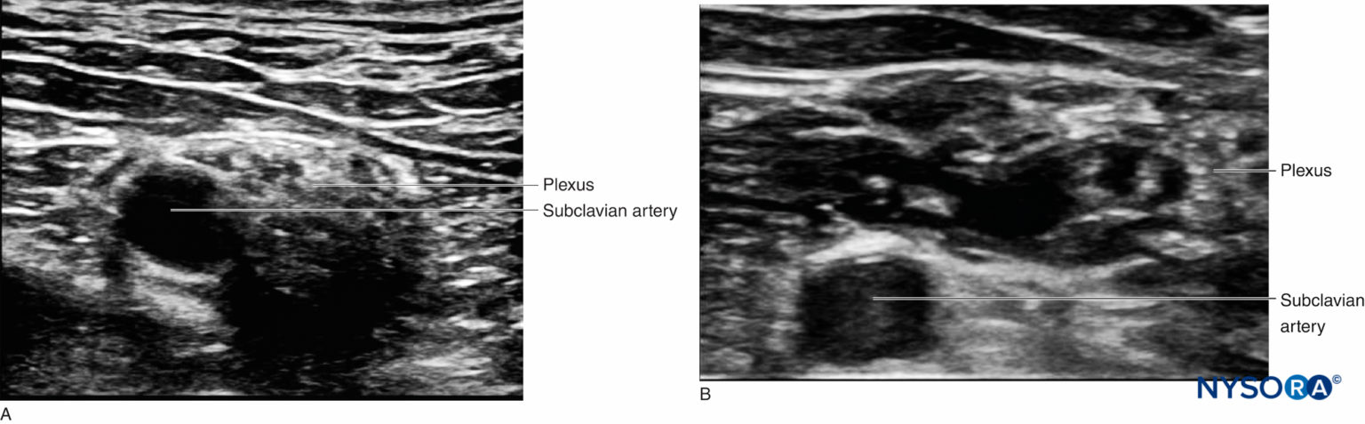 Ultrasound-Guided Interscalene Brachial Plexus Nerve Block - NYSORA