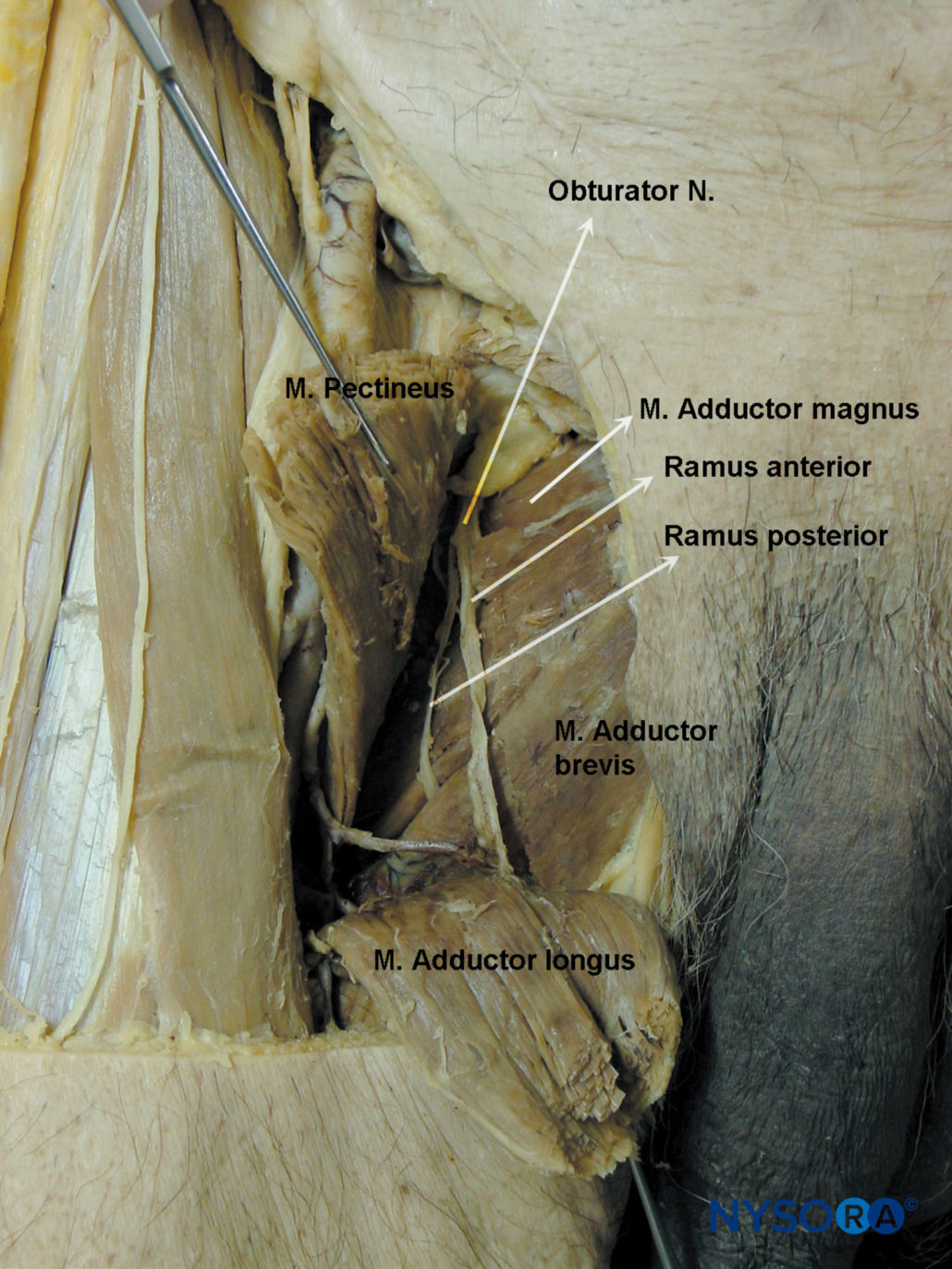 Regional Anesthesia Distribution Of Anterior And Posterior Divisions Of Obturator Nerve After