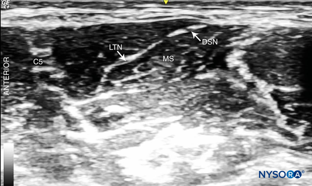 Ultrasound-Guided Interscalene Brachial Plexus Nerve Block - NYSORA