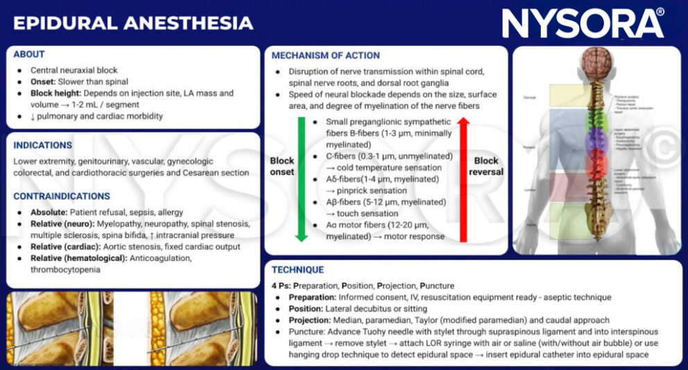 Epidural Anesthesia and Analgesia - NYSORA