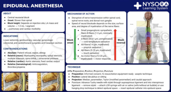 Epidural Anesthesia and Analgesia - NYSORA