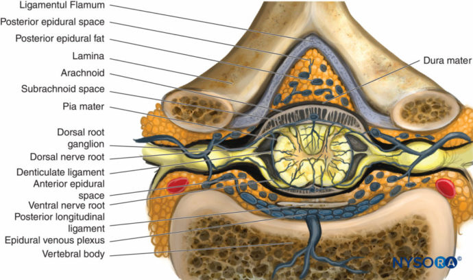 Anestesia y Analgesia Epidural - NYSORA